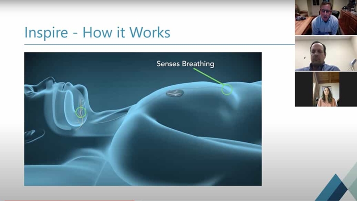 Inspire Sleep Apnea Videos